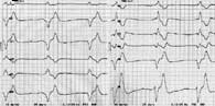 EKG Quiz 19