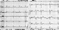 EKG Quiz 19